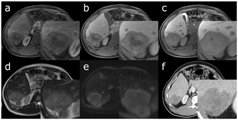 The Diagnostic Approach Towards Combined Hepatocellular
