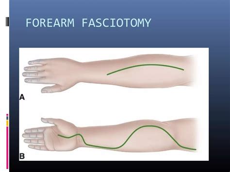 Fasciotomy Ppt