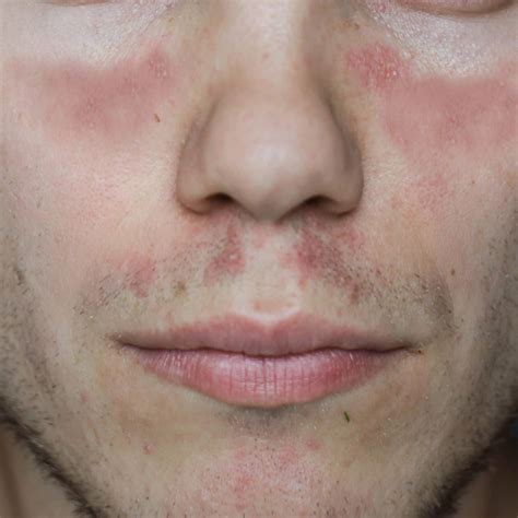 Lupus Butterfly Rash On Face