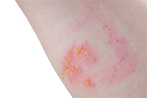 Does Poison Ivy Die In The Winter
