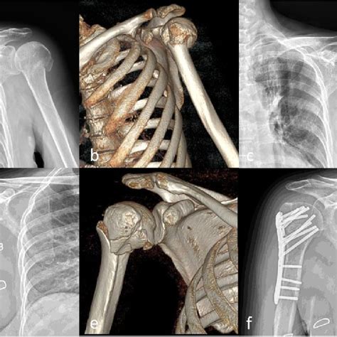 A Radiograph Of A Year Old Woman With Neer Classification Of Download Scientific Diagram