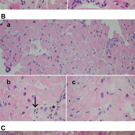 Endomyocardial Fibrosis In Hypertrophic Cardiomyopathy Increased