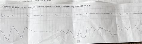 30 Yo Female Cc Intermittent Episodes Of Palpitations And Dyspnea R Ekgs
