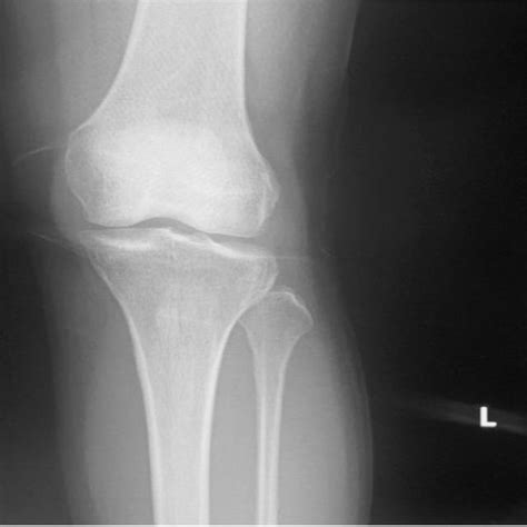 How To Use The Knee Joint Detection Object Detection Api