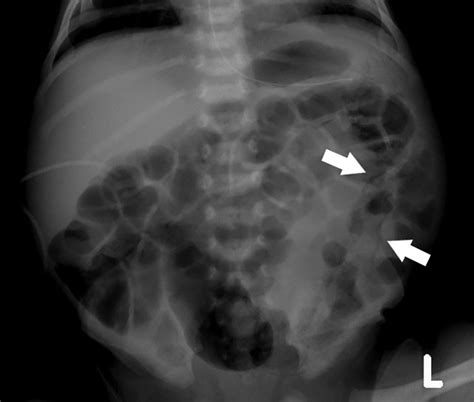 Intestinal Loop On X Ray At Nicholas Ramsey Blog