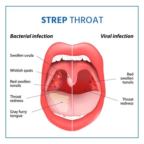 Strep Throat Symptoms, Causes and Treatment