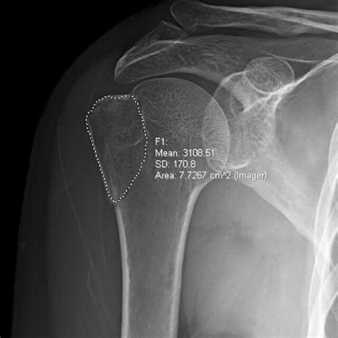 Area Of The Greater Tuberosity Fragment Was Measured Using The Tool