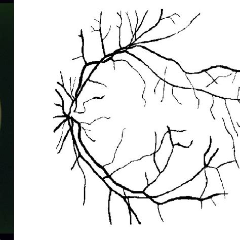 Retinal Vessel Segmentation Using Resnet Unet A Actual Image B