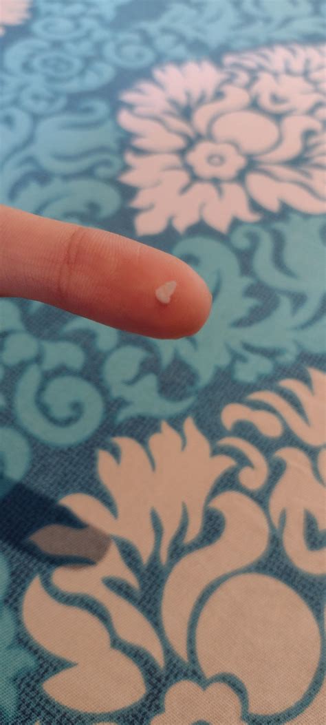 I Chipped Off A Tiny Piece Of My Tooth Yet Again How Many Of You Experience This R Brittlebones