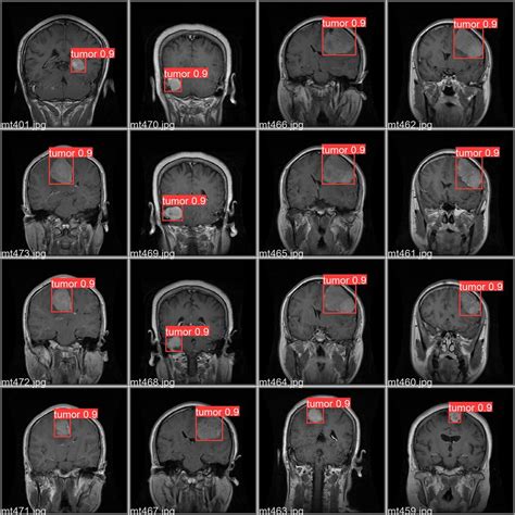 brain tumor detection using yolov5 kaggle