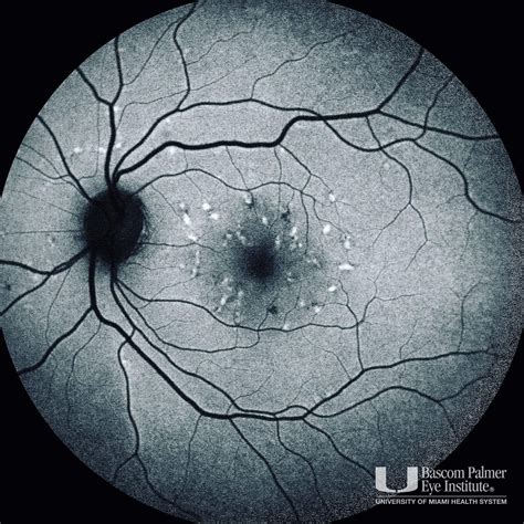 Mp101921oi Multifocal Pattern Dystrophy Bascom Palmer