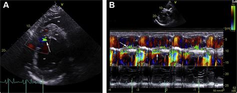 Color Flow Doppler A And Color M Mode Echocardiography B Of The Download Scientific Diagram
