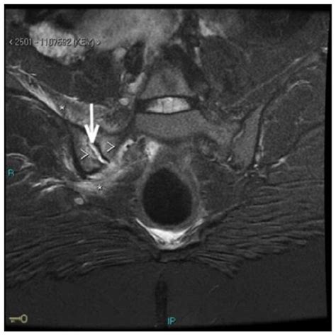 Pelvic Mri On Admission Showing Bone Marrow Edema Arrowheads Small