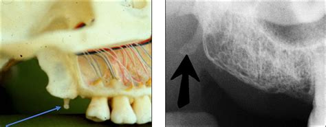 Coronoid Process Radiograph