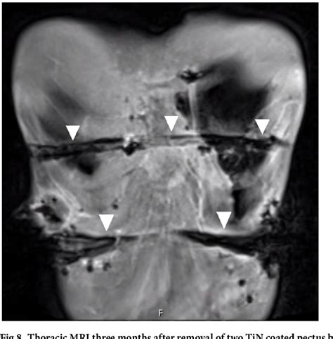 Figure 8 From Titanium Nitride Coating Of Pectus Bar Increases Metal Contamination After