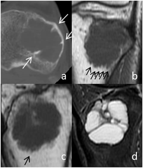 A 59 Year Old Man With A Giant Cell Tumor Of Bone In The Proximal Tibia Download Scientific