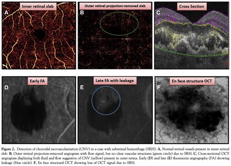 Detection Of Choroidal Neovascularization Cnv In A Case With