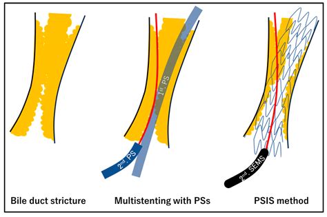 Bile Duct Stent Survival Rates