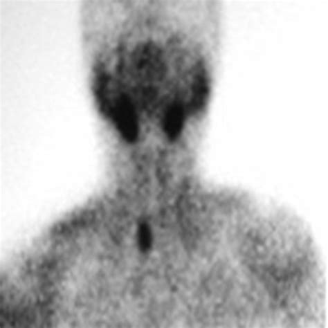 Radioisotope Scan Tc 99 M Sestamibi Depicted A Right Parathyroid Download Scientific Diagram