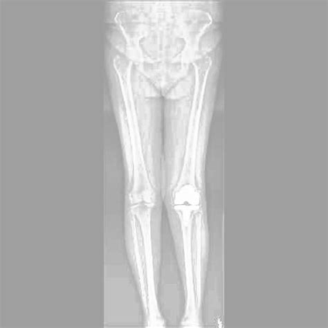 Knee Detector Object Detection Model By Bone Lesion Classifier