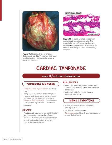 Constrictive Pericarditis Gross