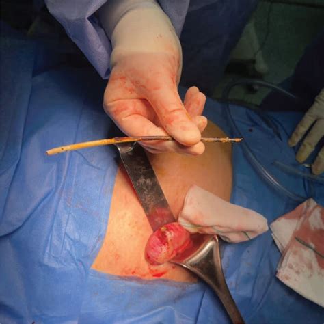 Pulled Out Ercp Stent From The Cecum Download Scientific Diagram