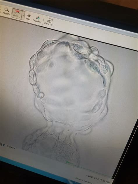 Blastocyst Hatching Irbid Specialty Hospital مستشفى اربد التخصصي