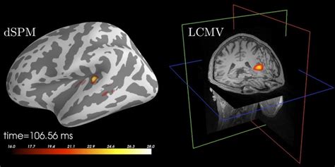 Source Localization Of An Auditory N100 Component Left Results Download Scientific Diagram