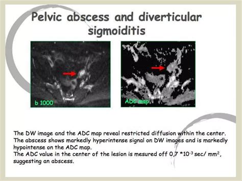 Presentation1 Radiological Application Of Diffusion Weighted Images In Abdome And Pelvic