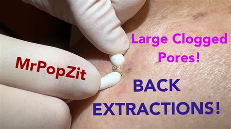 Armpit Extractions 2 Blackheads Whiteheads Milia Cyst Pops Q Tip Extractions On Axilla