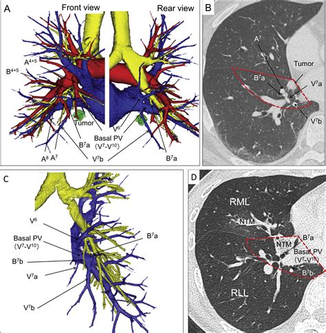 Thoracoscopic Medial Basal Segment Segmentectomy The Annals Of Thoracic Surgery