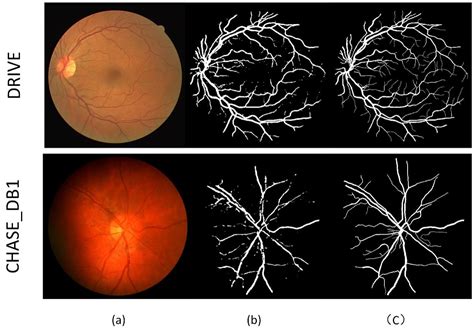 Improvement Of Retinal Vessel Segmentation Method Based On U Net
