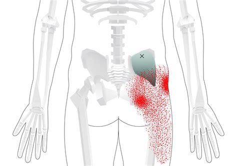 Gluteus Medius Trigger Points