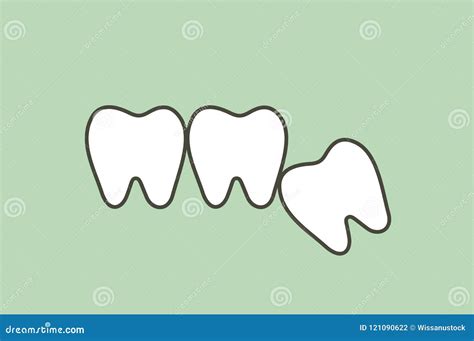 Wisdom Tooth Angular Or Mesial Impaction Affect To Other Teeth Stock Vector Illustration Of