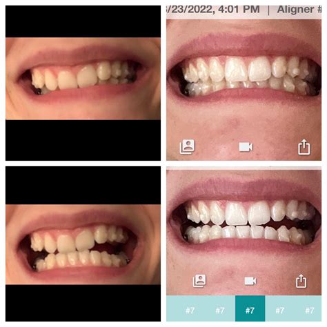 Bite Progress Pictures More Info In The Comments Rinvisalign