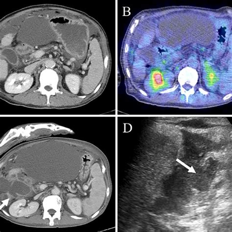 Figure4imaging Of The First Gallbladder Perforation Ct Revealed No