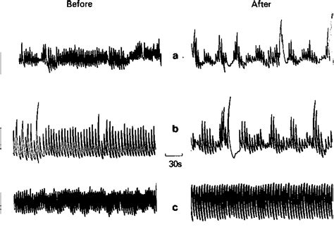 Figure 1 From Ventilatory Patterns In Surgical Patients Premedicated