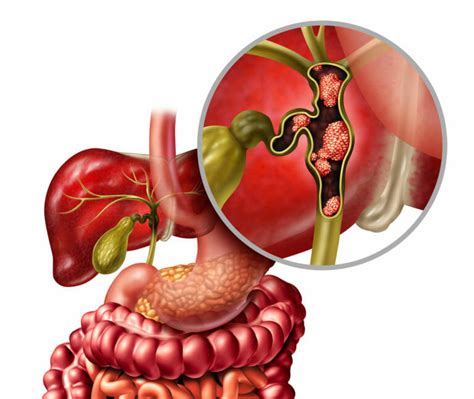 Cholangiocarcinoma Diagnosis And Disease Information