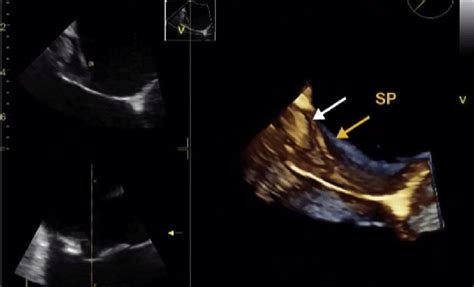 Three Dimensional Image Showing The Sp Yellow Arrow At The Left