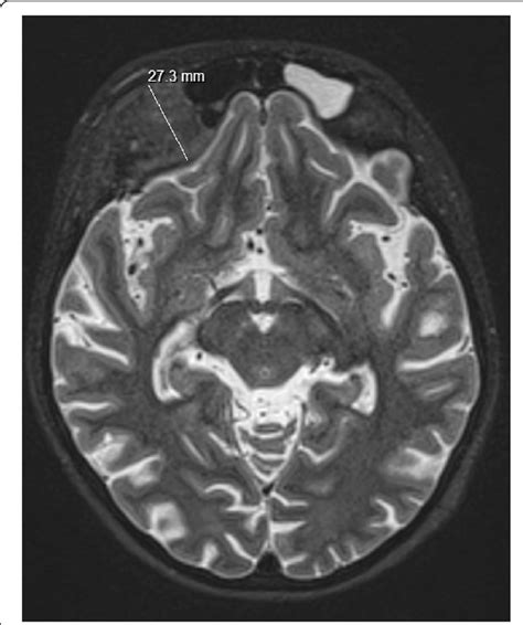 Mri Of The Patients Head Measuring Of Hyperostosis Of Frontal Bone On Download Scientific