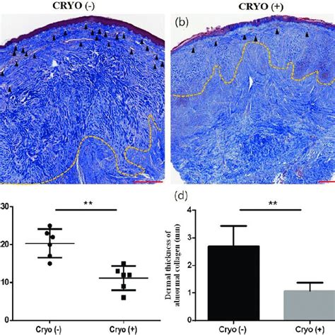 Histologic Analysis Of Keloids Treated With Cryotherapy Hematoxylin