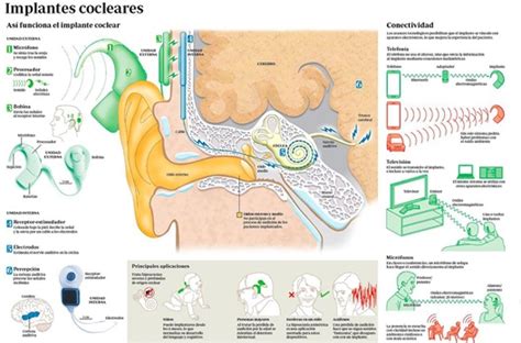 Partes De Um Diagrama De Implante Coclear