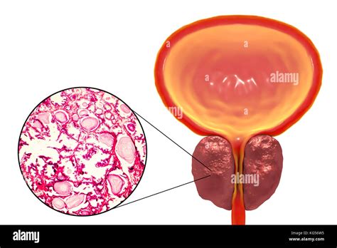 Benign Prostatic Hyperplasia Hi Res Stock Photography And Images Alamy