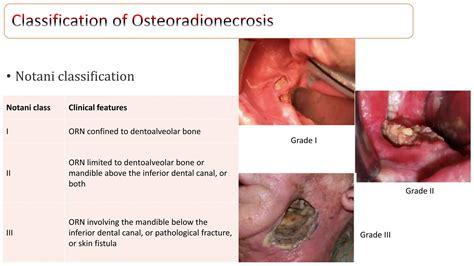 Osteoradionecrosispptx