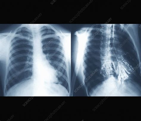 Bronchiectasis X Ray Stock Image C026 9934 Science Photo Library