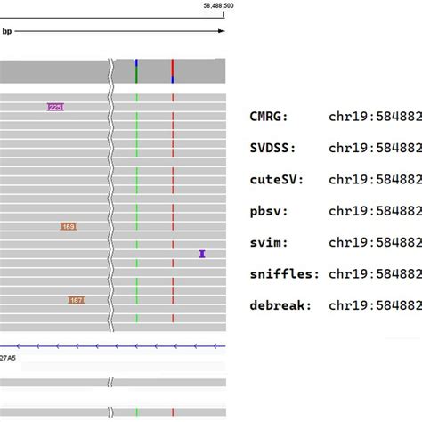 Example Of An Sv At A Medically Relevant Gene That Has Been Correctly