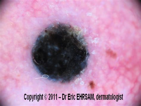 Dermoscopy Scalp Lesion Dermoscopy Scalp Lesion