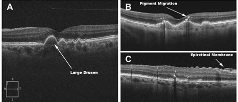 A On Optical Coherence Tomography Oct Cirrus Hd Oct