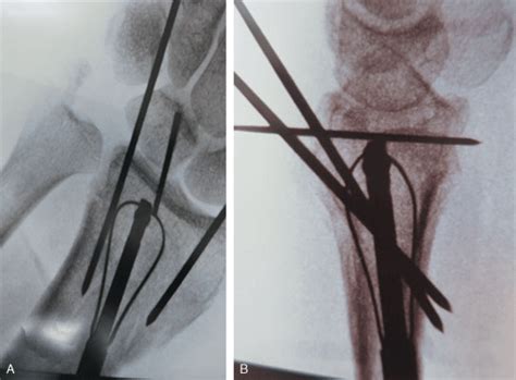 Anteroposterior A And Lateral B Fluoroscopic Images Depicting The