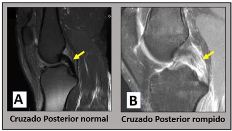 Ligamento Cruzado Posterior Especialista Em Joelho